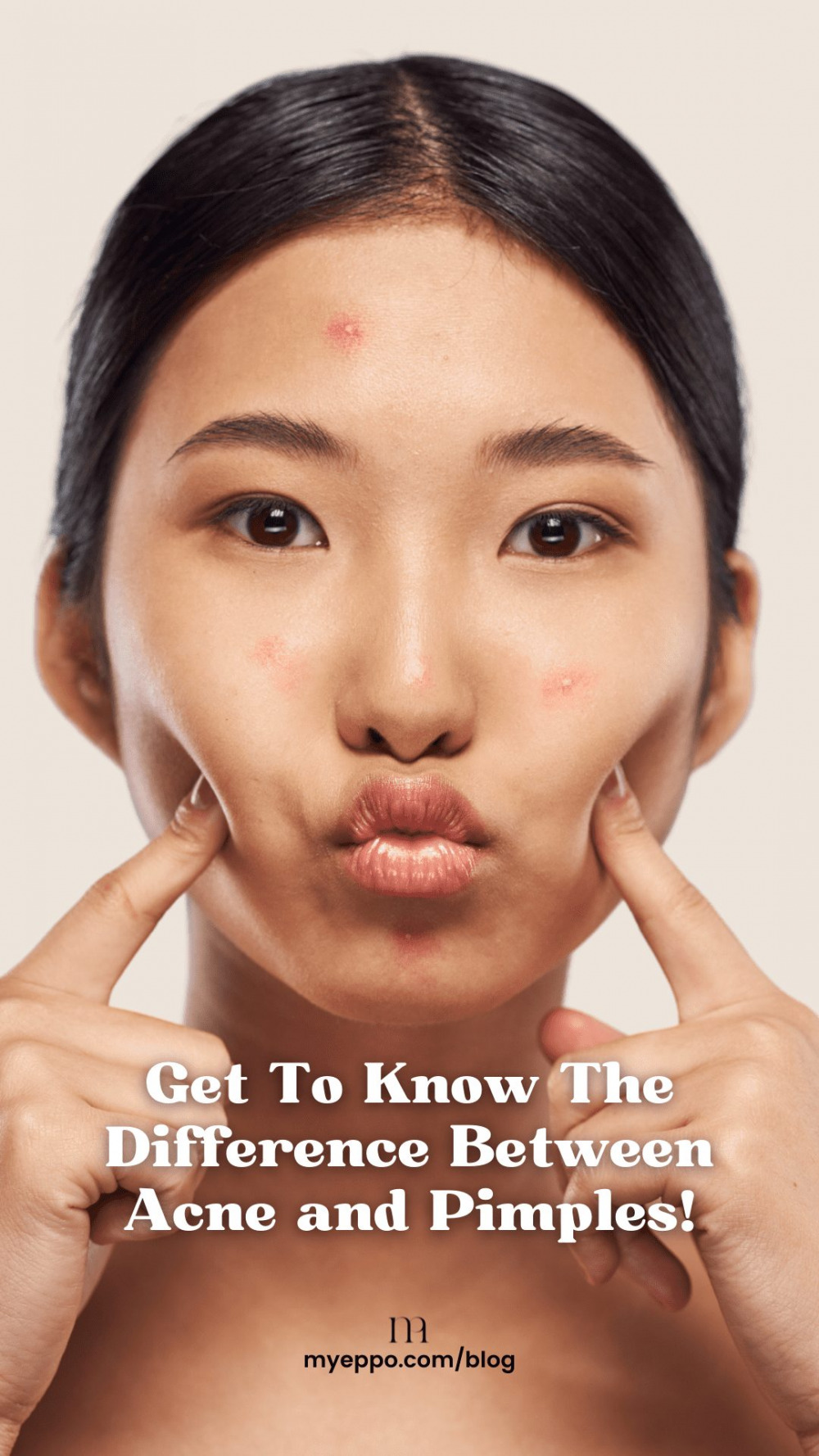 Get To Know The Difference Between Acne and Pimples! | myeppo.
